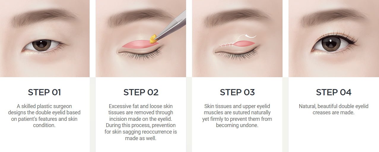 Incision double eyelid surgery in Korea - Medictel